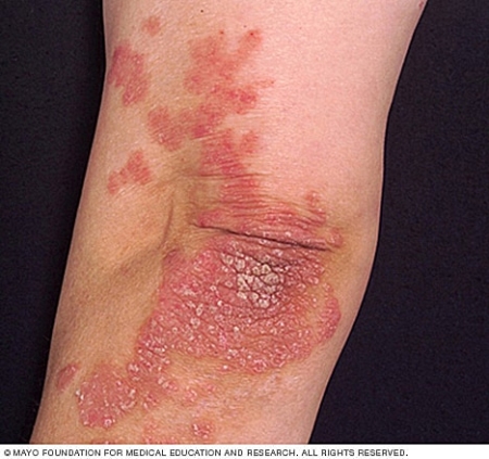 Psoriasis & Eczema - Alaska Family Dermatology